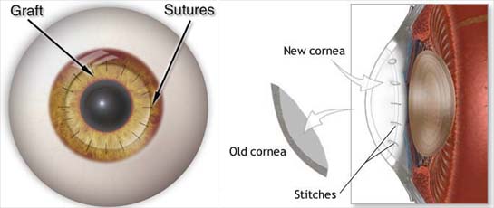 Corneal Transplant Surgery Scotland | Ayrshire Eye Clinic