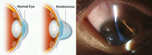 Ketatoconus Treatment Scotland | Ayrshire Eye Clinic
